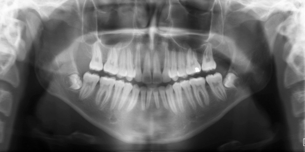 To Close or Not to Close? That is the Question: An Orthodontic ...