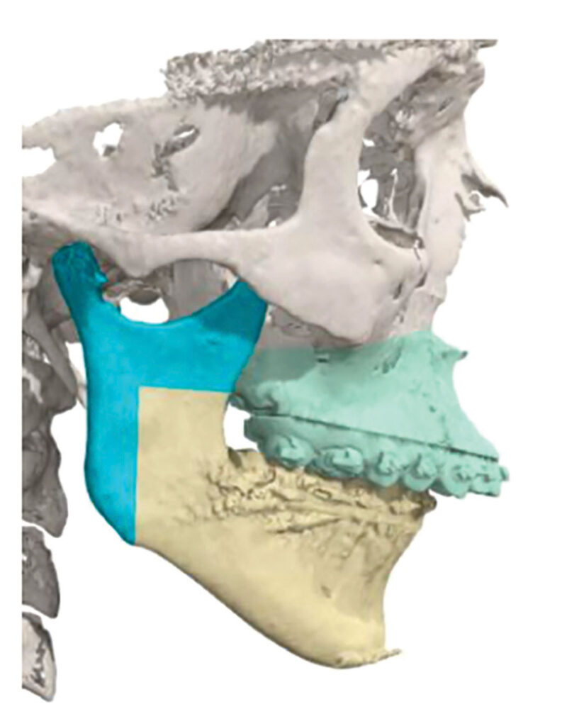Orthognathic Surgery: Embracing Digital Technology