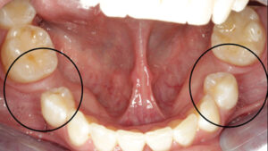 3D Reconstruction of Complex Bony Defects with Autogenous Bone