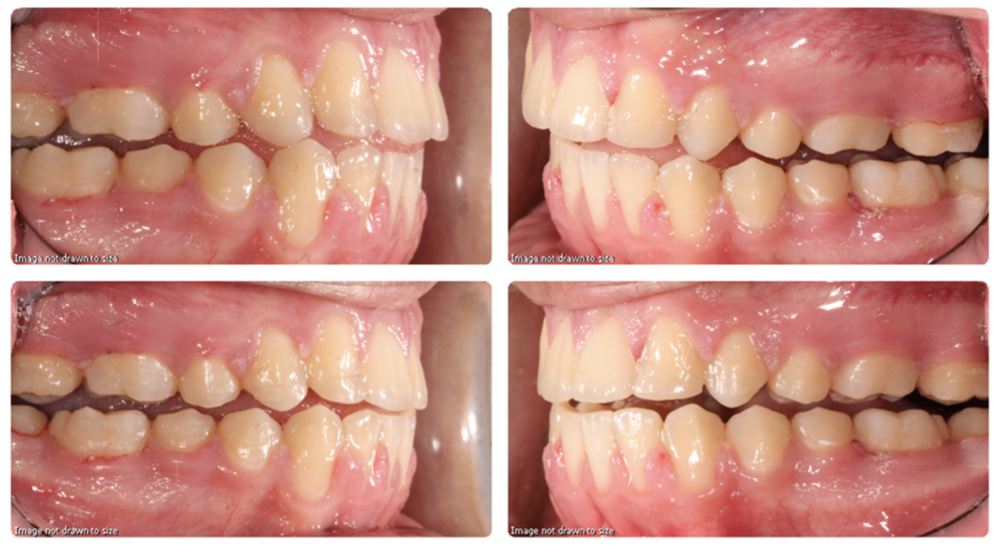 To Close or Not to Close? That is the Question: An Orthodontic ...