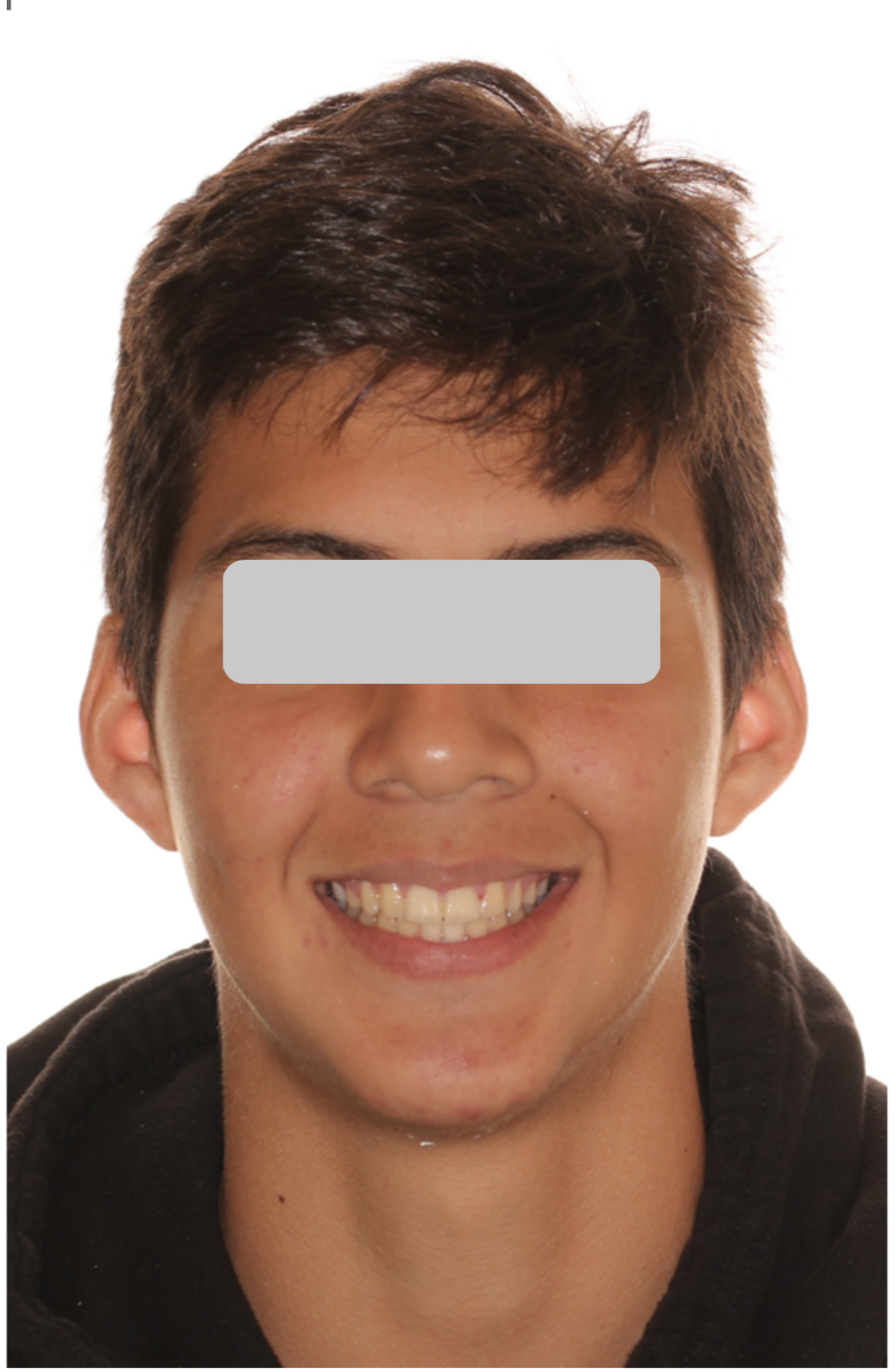 To Close or Not to Close? That is the Question: An Orthodontic ...