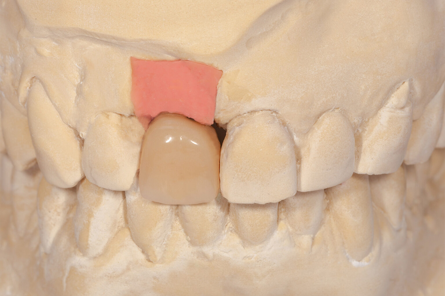 Replacement of a Central Incisor with a Transepithelial Component and ...