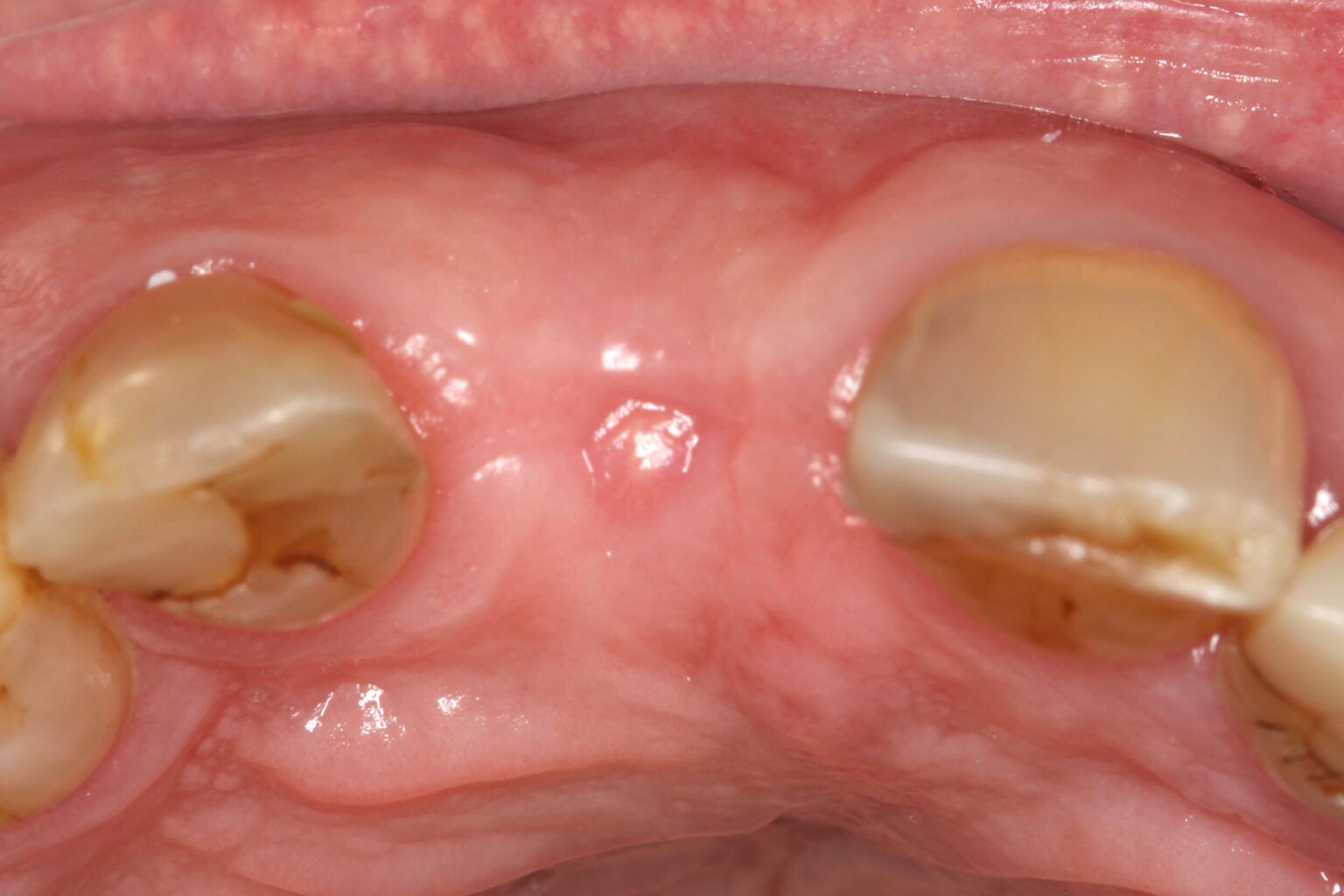 Replacement of a Central Incisor with a Transepithelial Component and ...