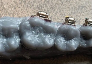 The New Era of Personalized Orthodontics: 3D Printed Braces