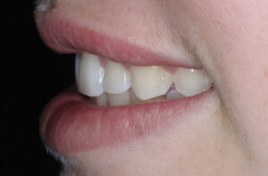 The New Era of Personalized Orthodontics: 3D Printed Braces