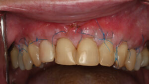 Soft Tissue Grafting Using Allograft: A Case Report