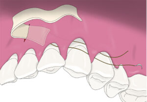 Soft Tissue Grafting Using Allograft: A Case Report