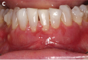 Periodontal Phenotype Modification for Patients Receiving Orthodontic ...