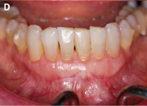 Periodontal Phenotype Modification for Patients Receiving Orthodontic ...