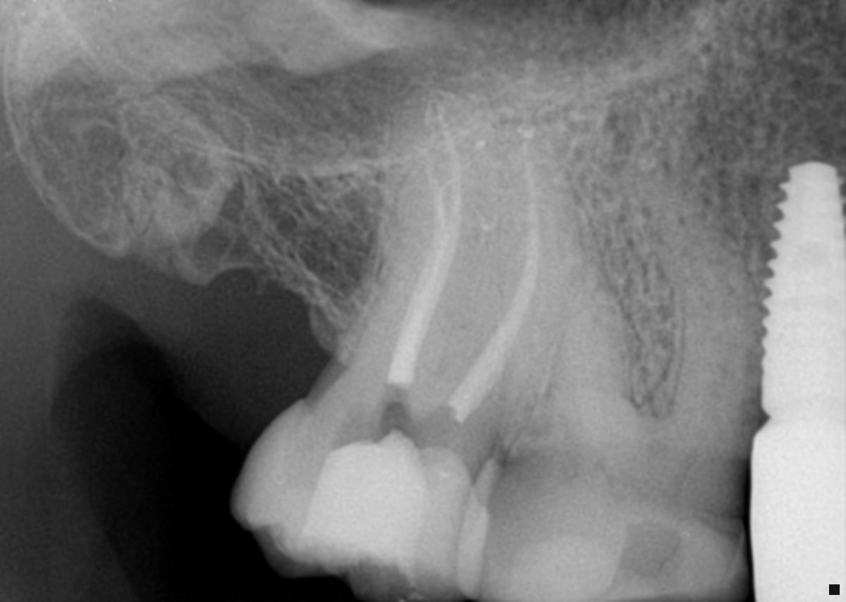 Transforming Every Day Endodontics: 5 Compelling Reasons for Choosing ...
