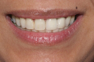 The Role of Orthodontic Extrusion and Intrusion in Implant Prosthodontics