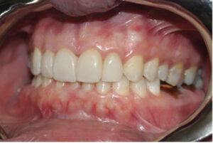 The Role of Orthodontic Extrusion and Intrusion in Implant Prosthodontics