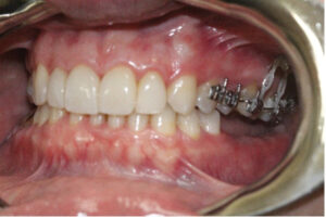 The Role of Orthodontic Extrusion and Intrusion in Implant Prosthodontics
