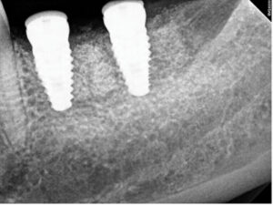 The Role of Orthodontic Extrusion and Intrusion in Implant Prosthodontics