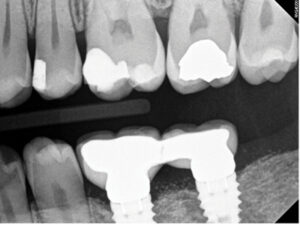 The Role of Orthodontic Extrusion and Intrusion in Implant Prosthodontics