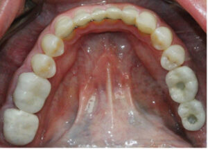 The Role of Orthodontic Extrusion and Intrusion in Implant Prosthodontics