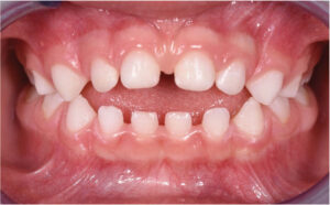 Pacifier Use as a Cause of Malocclusions: How to Stop the Habit and ...