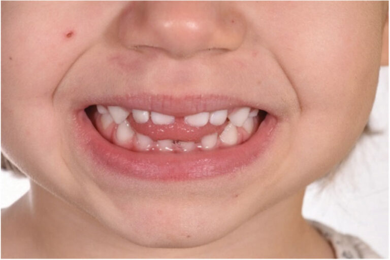 Pacifier Use as a Cause of Malocclusions: How to Stop the Habit and ...