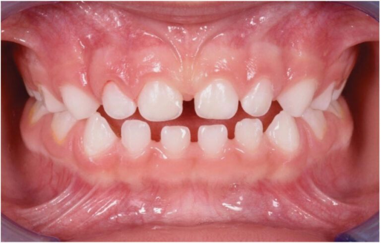 Pacifier Use as a Cause of Malocclusions: How to Stop the Habit and ...