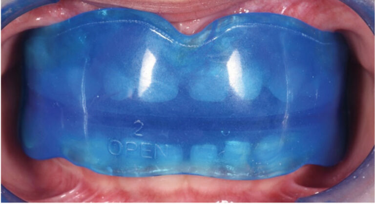 Pacifier Use as a Cause of Malocclusions: How to Stop the Habit and ...