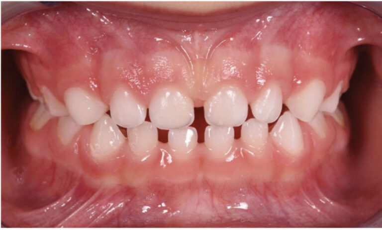 Pacifier Use as a Cause of Malocclusions: How to Stop the Habit and ...