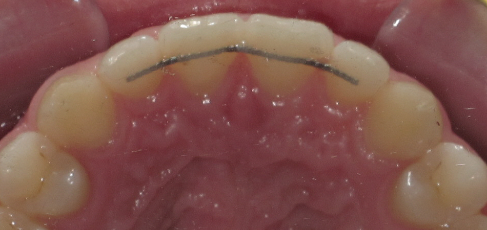 Retainers and the Importance of Orthodontic Retention