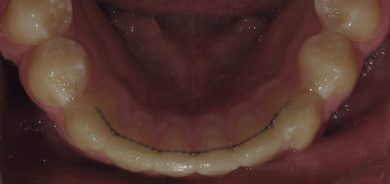 Retainers and the Importance of Orthodontic Retention