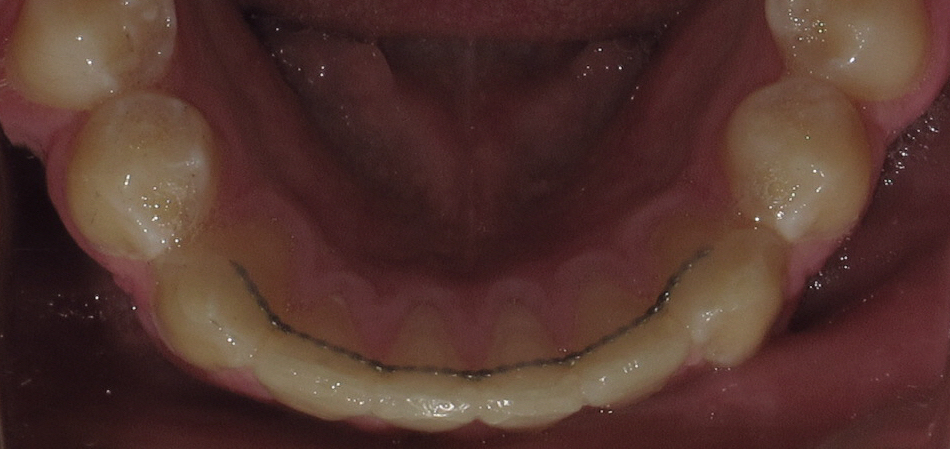 Retainers and the Importance of Orthodontic Retention