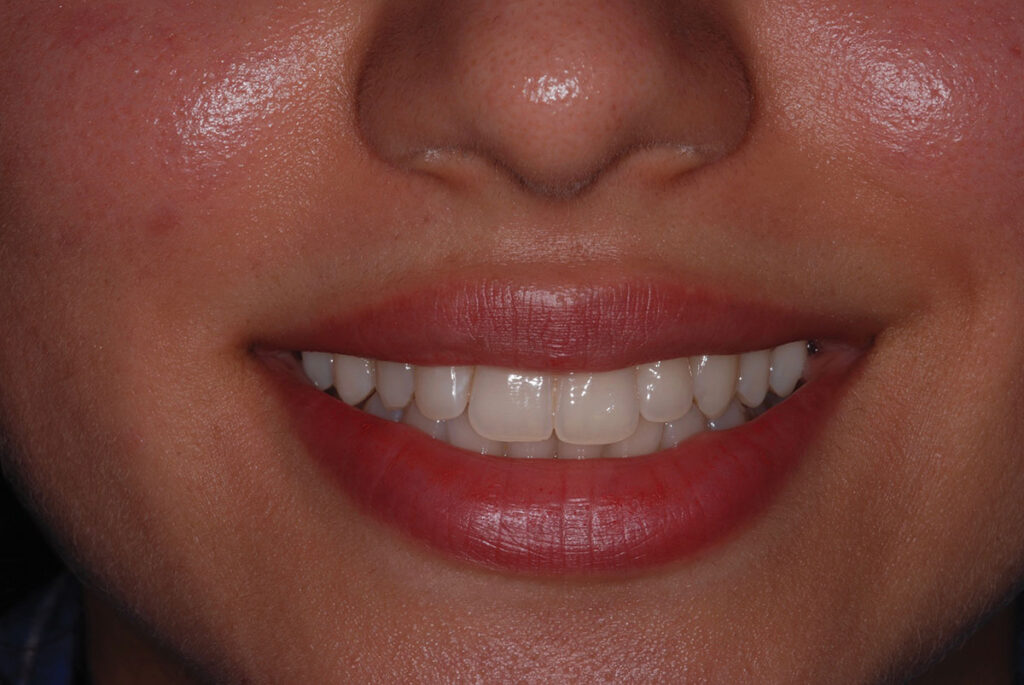 Clear Aligners: An Aesthetic Smile Makeover Using a Minimally Invasive ...