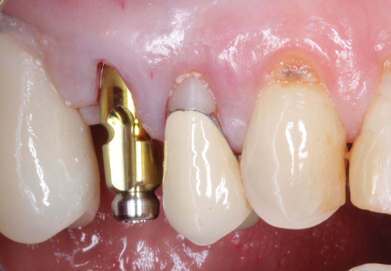 An Implant Osteotomy Paradigm Shift – Benefits of Minimally Invasive ...