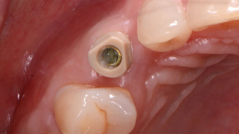 An Implant Osteotomy Paradigm Shift – Benefits of Minimally Invasive ...