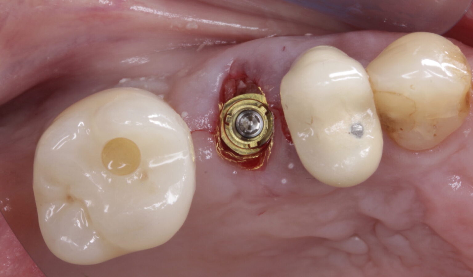 An Implant Osteotomy Paradigm Shift – Benefits of Minimally Invasive ...