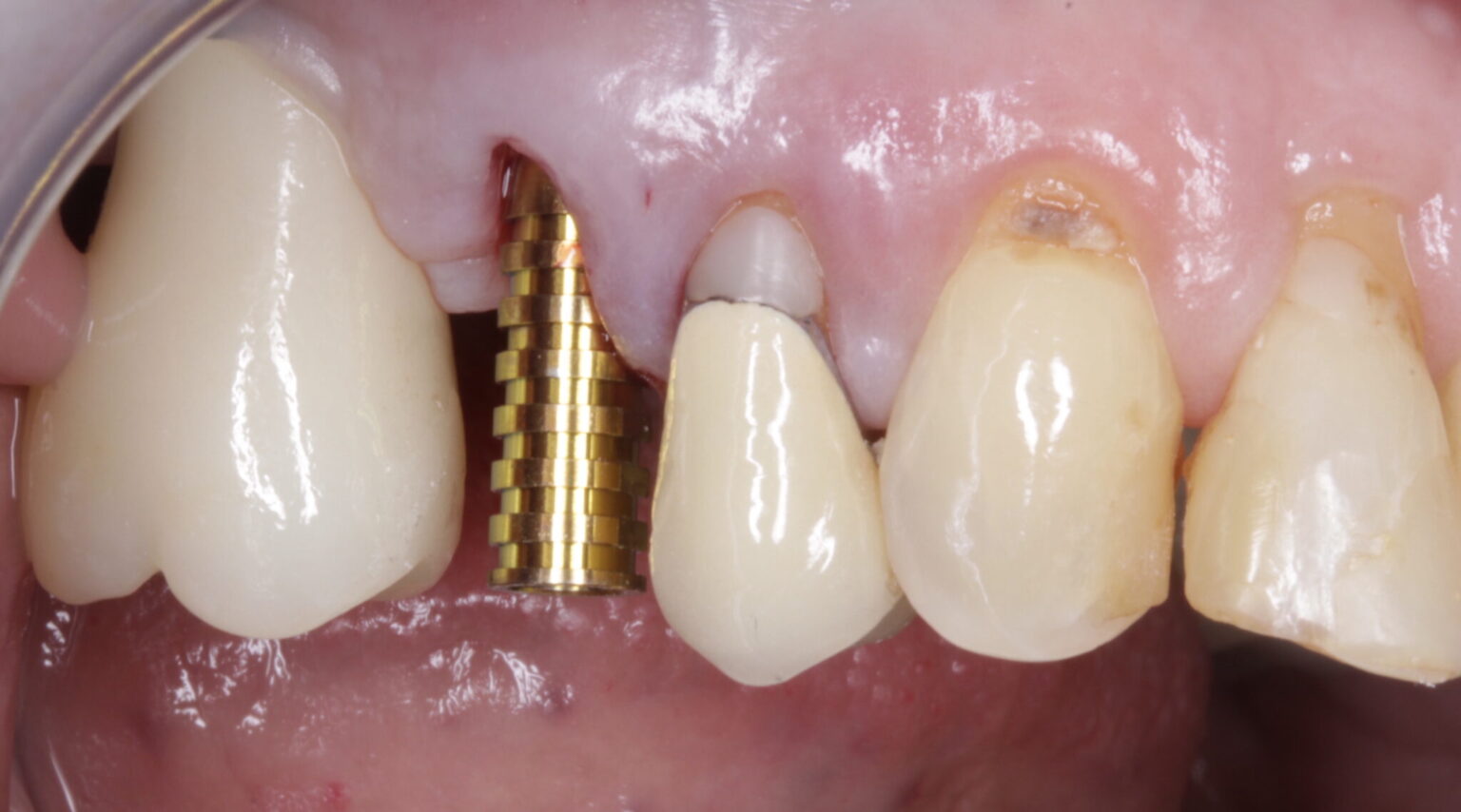 An Implant Osteotomy Paradigm Shift – Benefits of Minimally Invasive ...