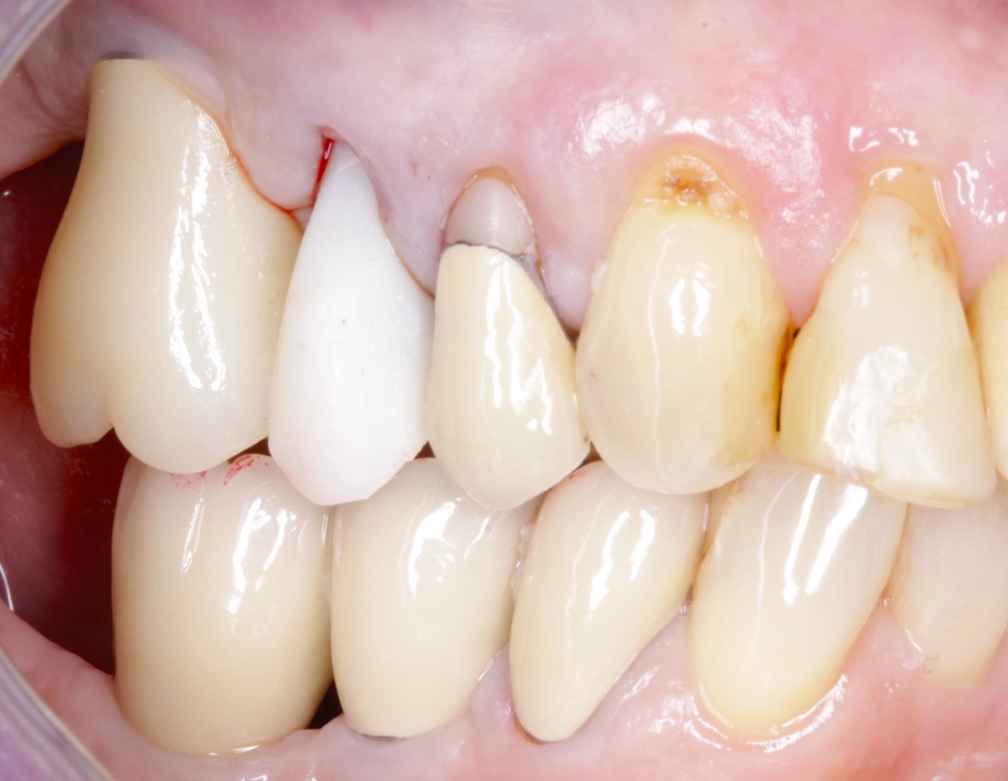 An Implant Osteotomy Paradigm Shift – Benefits of Minimally Invasive ...