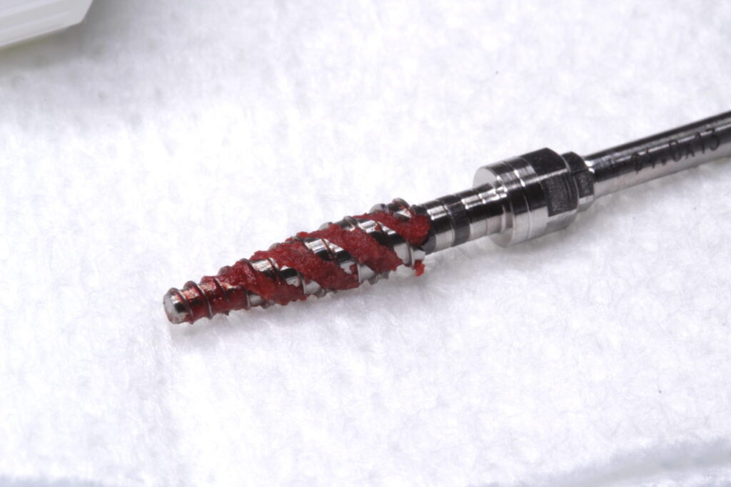 An Implant Osteotomy Paradigm Shift – Benefits of Minimally Invasive ...