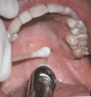 Maxillary Nerve Block via Greater Palatine Canal: An Olde Technique ...