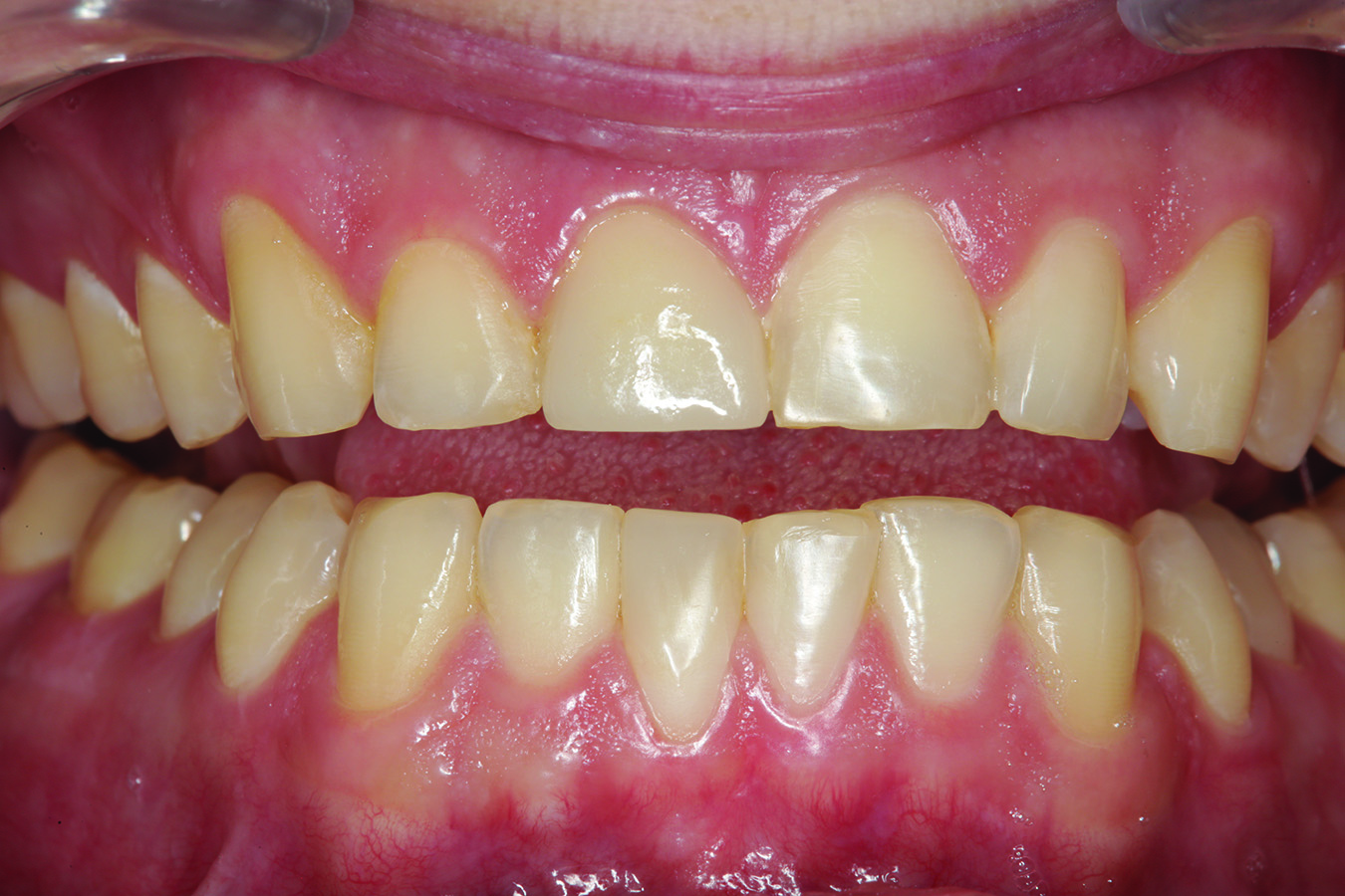 Conservative and Necessary: How Occlusion Can Effect a Single Tooth ...