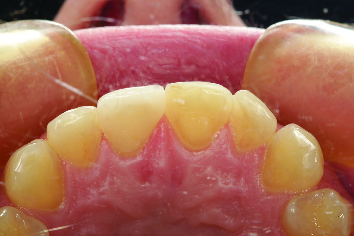 Conservative and Necessary: How Occlusion Can Effect a Single Tooth ...