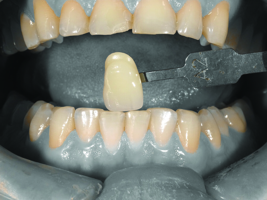 Conservative and Necessary: How Occlusion Can Effect a Single Tooth ...