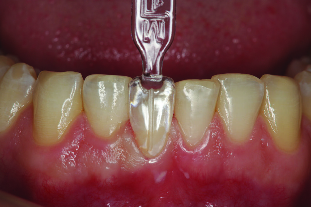 Conservative and Necessary: How Occlusion Can Effect a Single Tooth ...