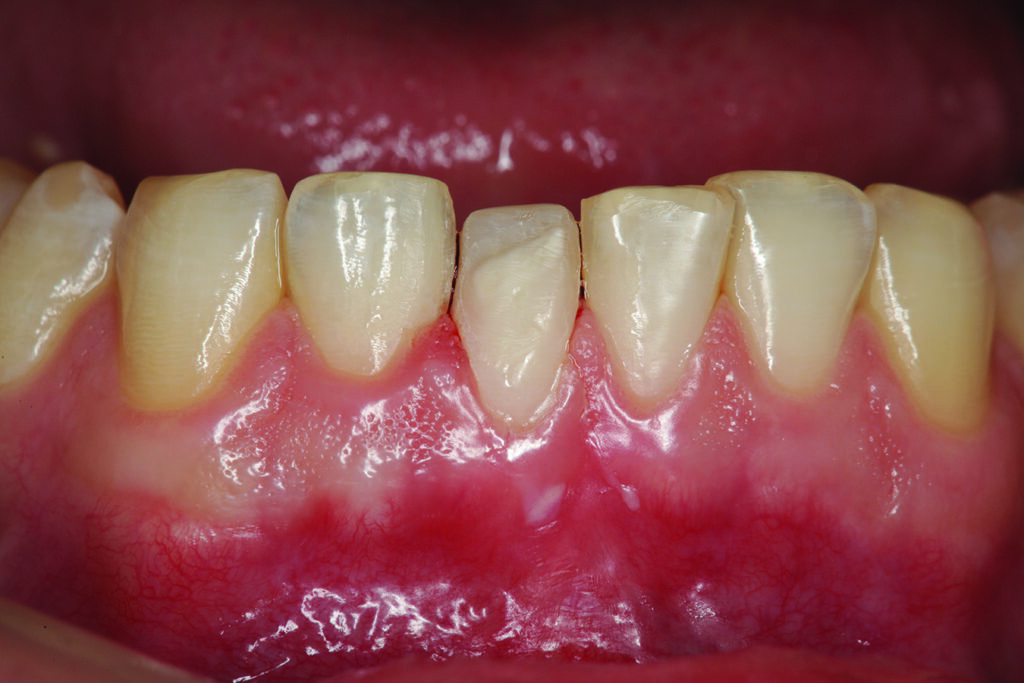 Conservative and Necessary: How Occlusion Can Effect a Single Tooth ...