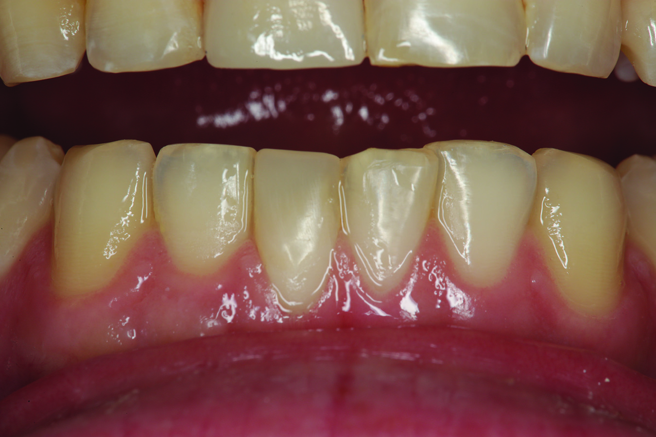 Conservative and Necessary: How Occlusion Can Effect a Single Tooth ...