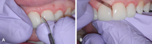 How does 3M™ Filtek™ Matrix enhance natural aesthetics in anterior ...