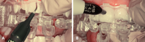 How does 3M™ Filtek™ Matrix enhance natural aesthetics in anterior ...