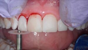 How does 3M™ Filtek™ Matrix enhance natural aesthetics in anterior ...