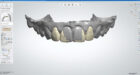 Direct Anterior Resin Composite Restorations: An Update on Esthetic ...