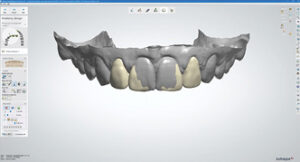 Direct Anterior Resin Composite Restorations: An Update on Esthetic ...