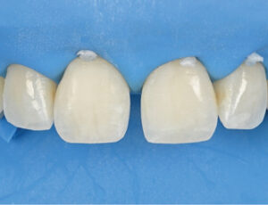 Direct Anterior Resin Composite Restorations: An Update on Esthetic ...