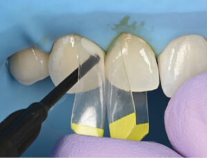 Direct Anterior Resin Composite Restorations: An Update on Esthetic ...