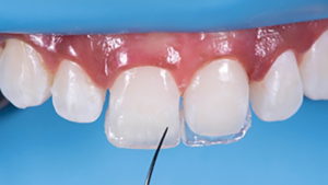 Direct Anterior Resin Composite Restorations: An Update on Esthetic ...